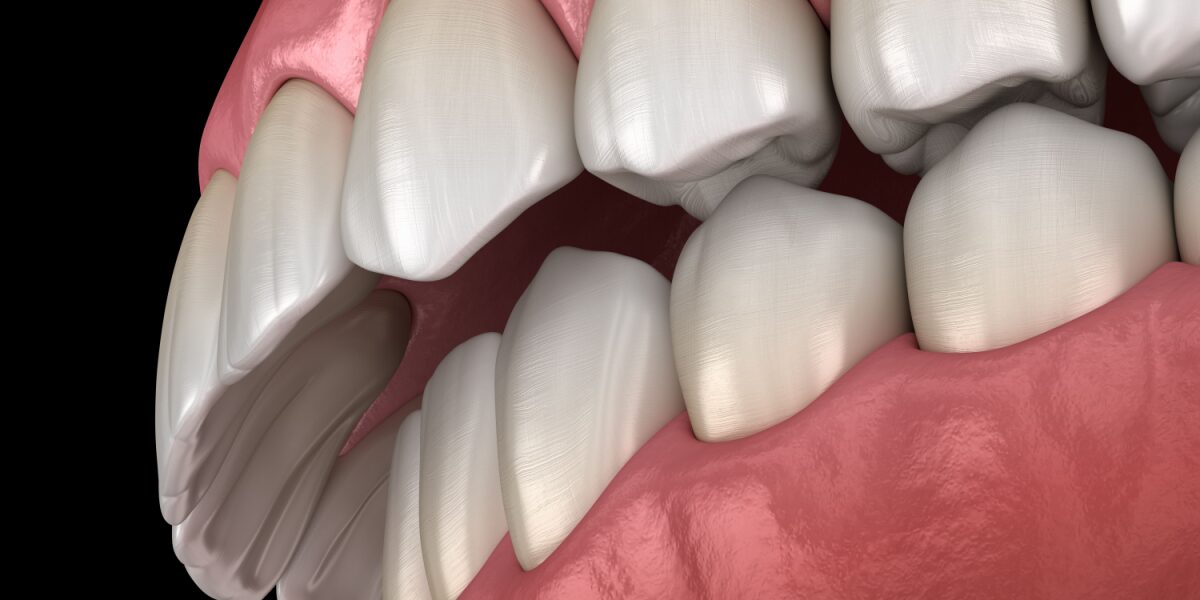 Sobremordida: causas y tratamientos - Sonría Clínica Dental